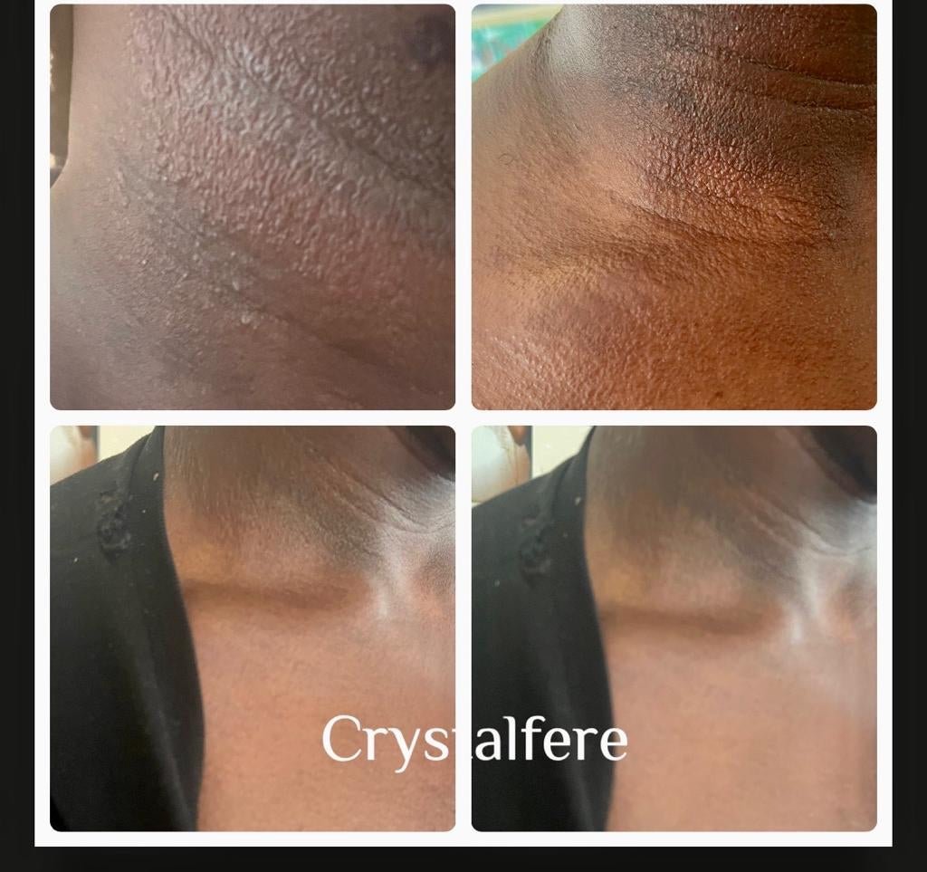 Skin problem butter and soap - eczema, ring worm , white patches and s ...